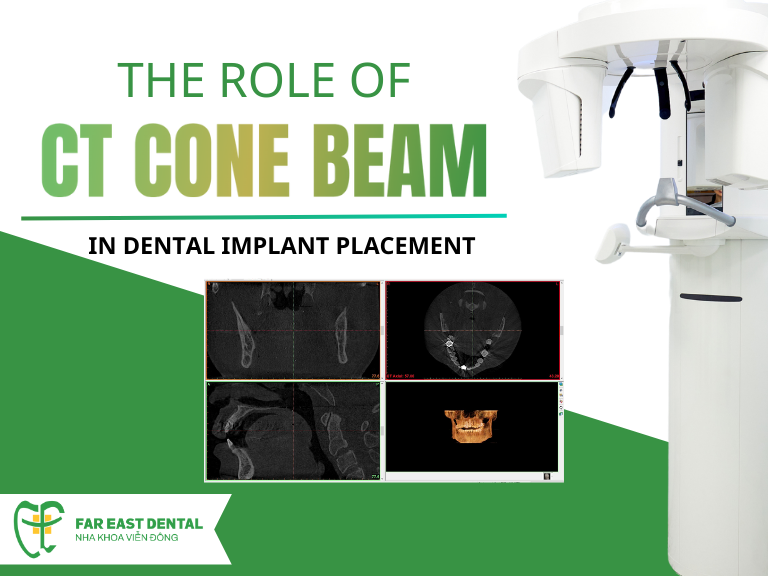 The significant role of CT Cone Beam imaging in dental Implant ...